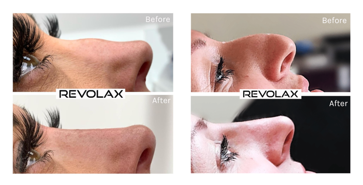 REVOLAX SUB-Q | Korean Fillers